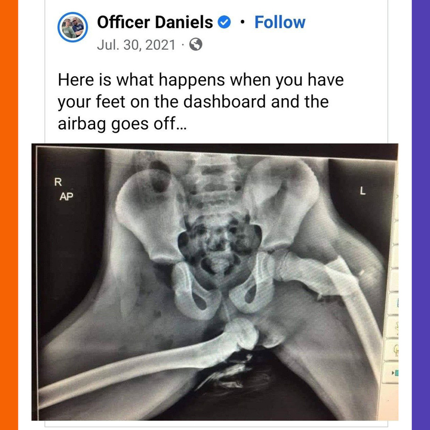 Shared post - What happens when your airbags go off with your feet on ...