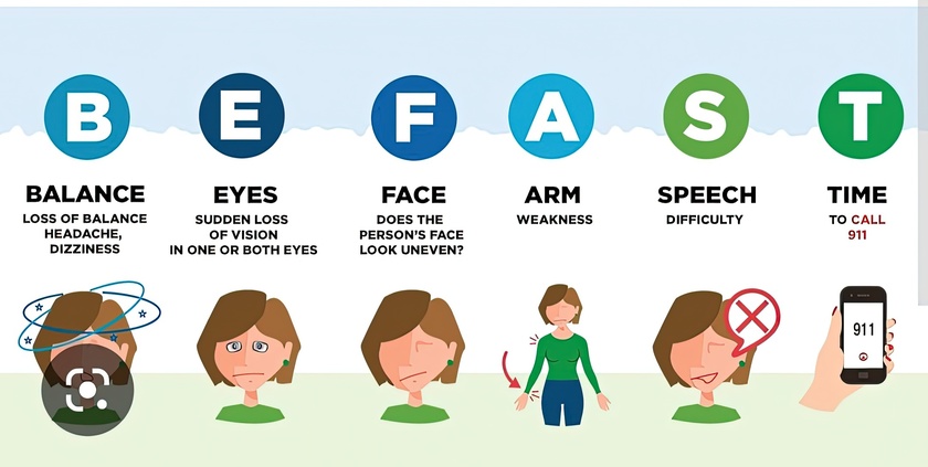 Shared post - Stroke Symptoms
